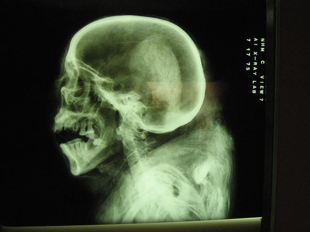 Bisturíes Ultrasónicos O Cómo Hacer Neurocirugía Sin Abrir El Cráneo